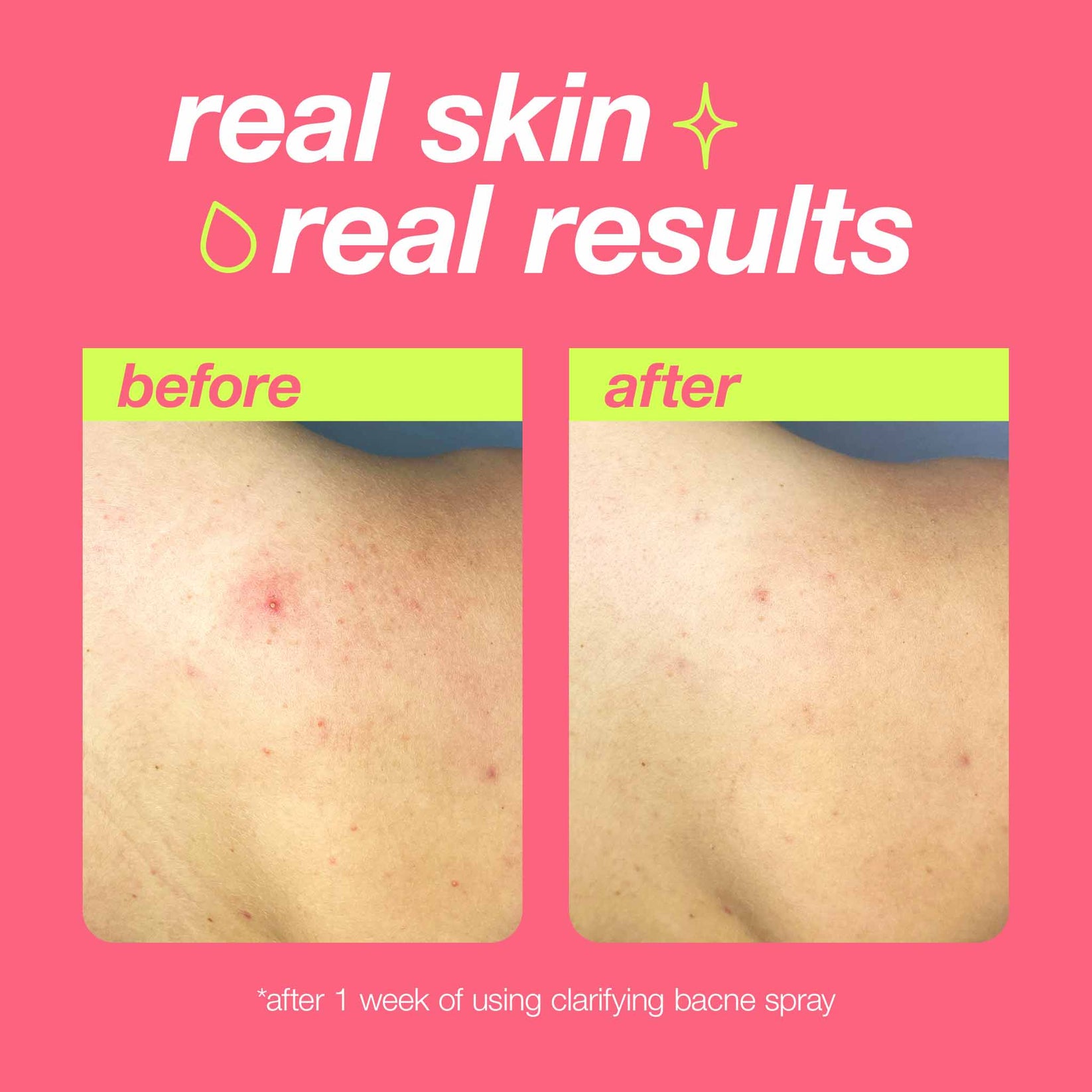 Clarifying Bacne Spray for Body Breakouts | Dermalogica®