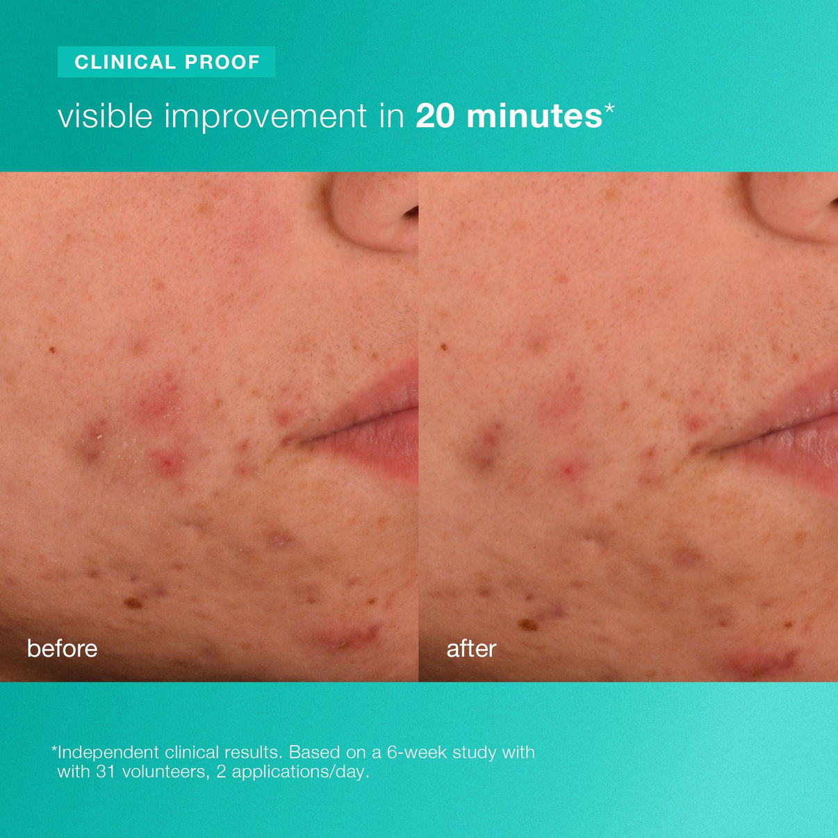 Acne Biotic Moisturizer | Dermalogica®