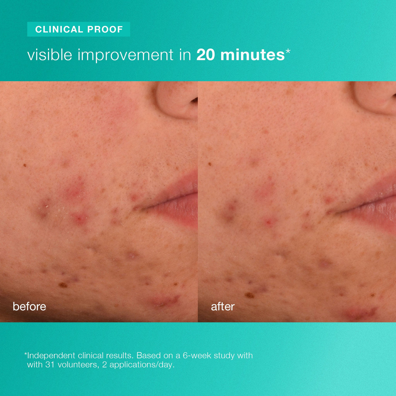 Acne Biotic Moisturizer | Dermalogica®