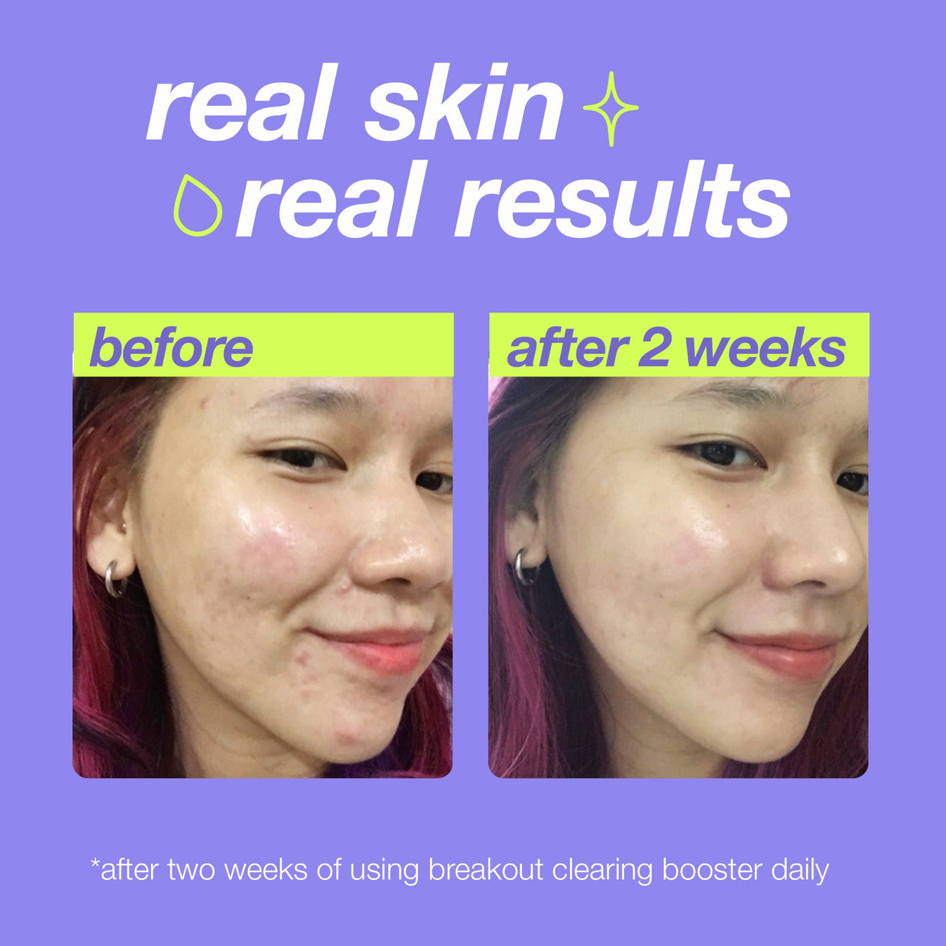 Breakout Clearing Booster, Teen Acne, Teen Skincare | Dermalogica®