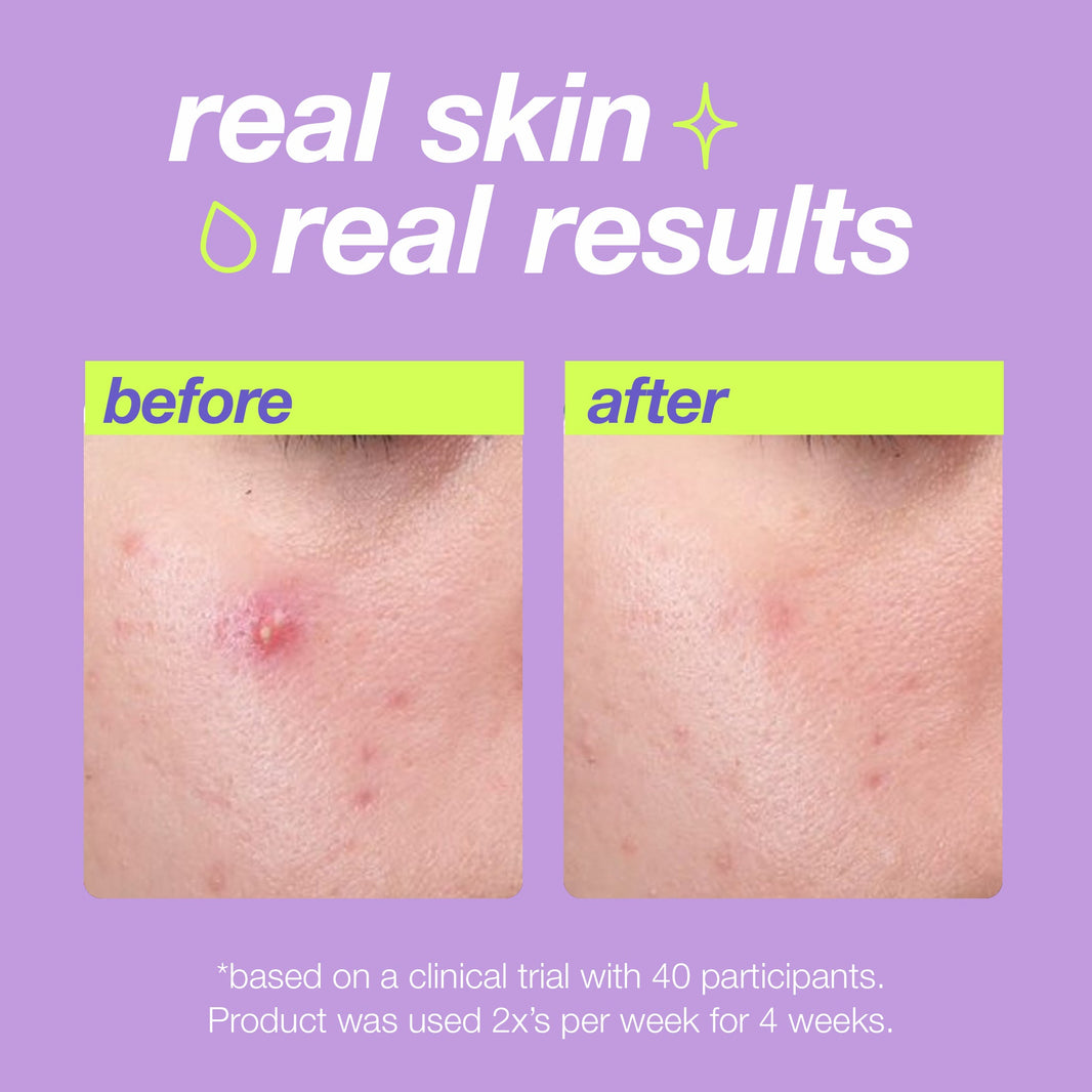 Target Breakouts & Blackheads With Clear Start | Dermalogica®